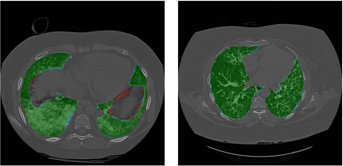 Extracting Lungs from CT Images Using Fully Convolutional Networks | Jeovane Honório Alves